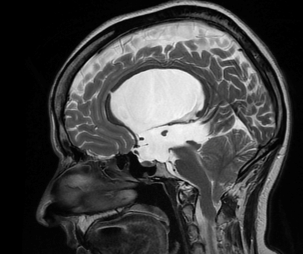 Pathologies crâniennes Tumeurs cérébrales - Neurochirurgie de l'Union ...