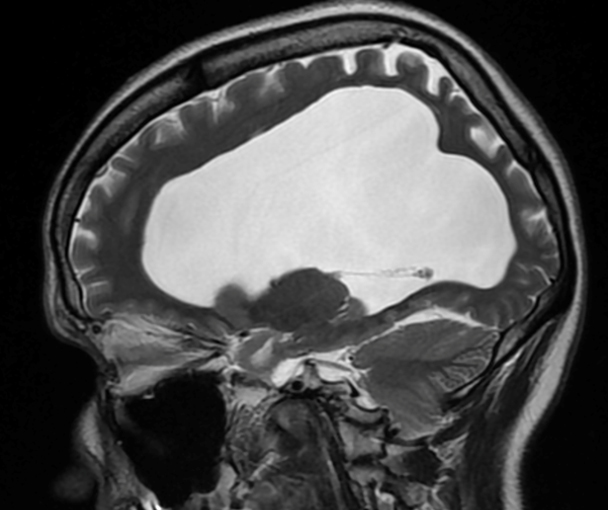 Pathologies crâniennes Tumeurs cérébrales - Neurochirurgie de l'Union ...